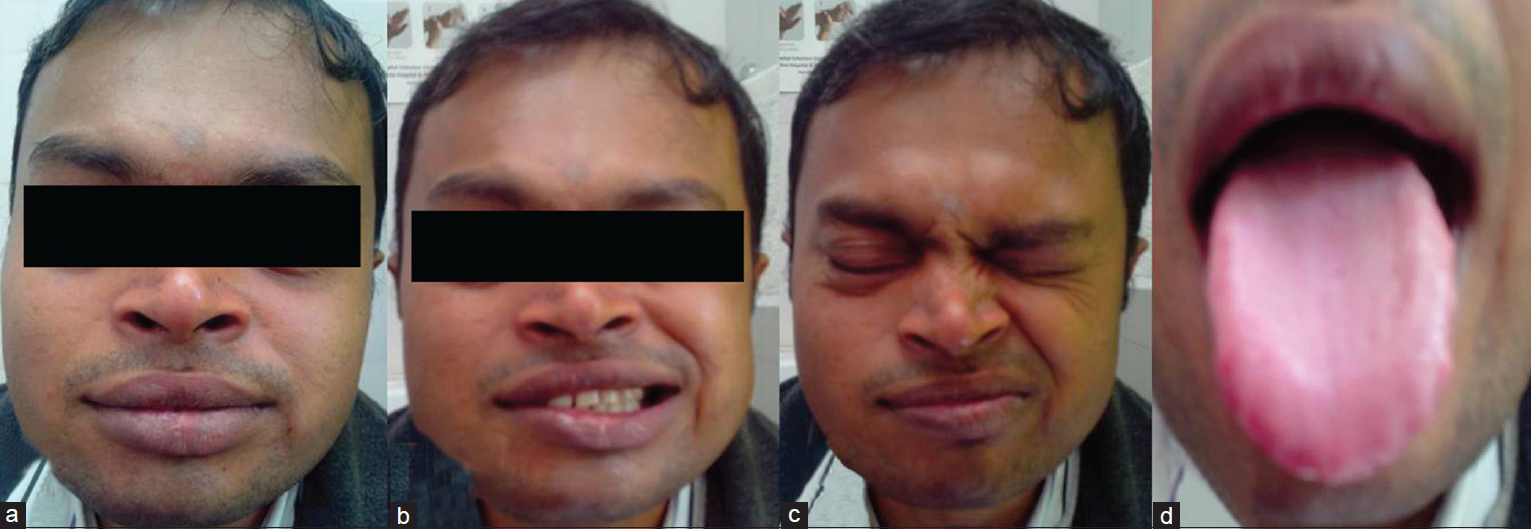 Melkersson-Rosenthal syndrome - Journal of Neurosciences in Rural Practice